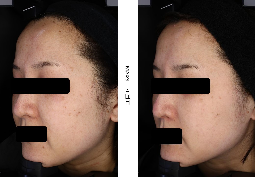 ICON MAXG（IPL）スーパーフォトセラピー | お花茶屋くじら皮膚科